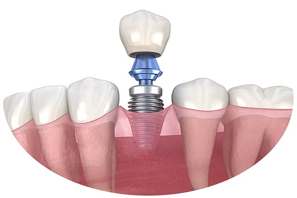 When and Why Should I Consider Dental Implants? – Site Title